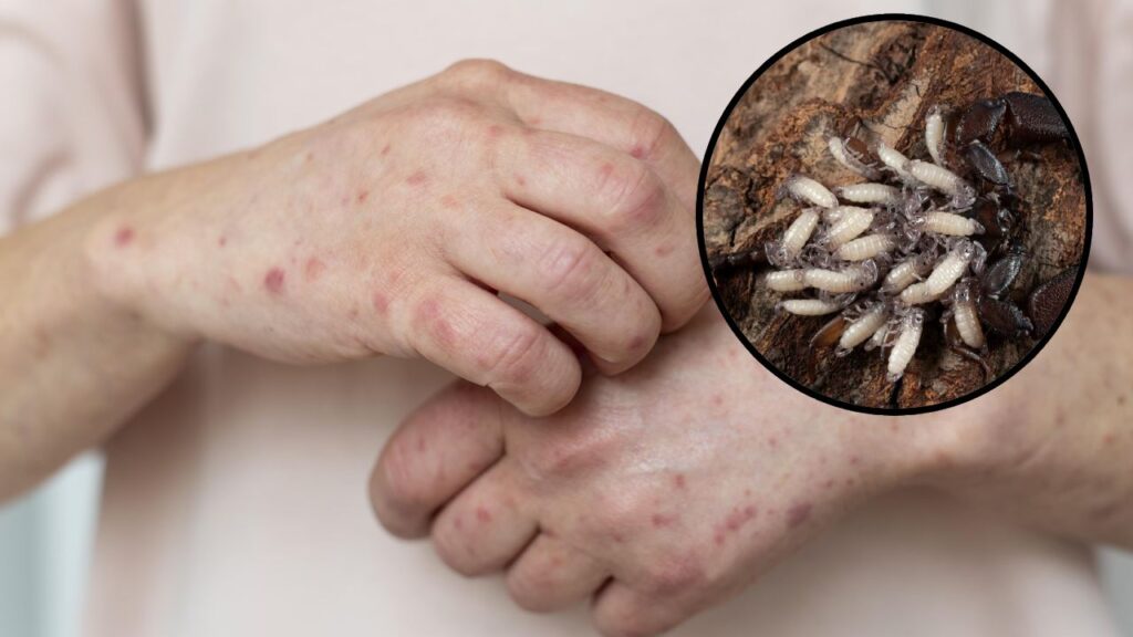 Detectan primer caso humano de miasis por gusano barrenador